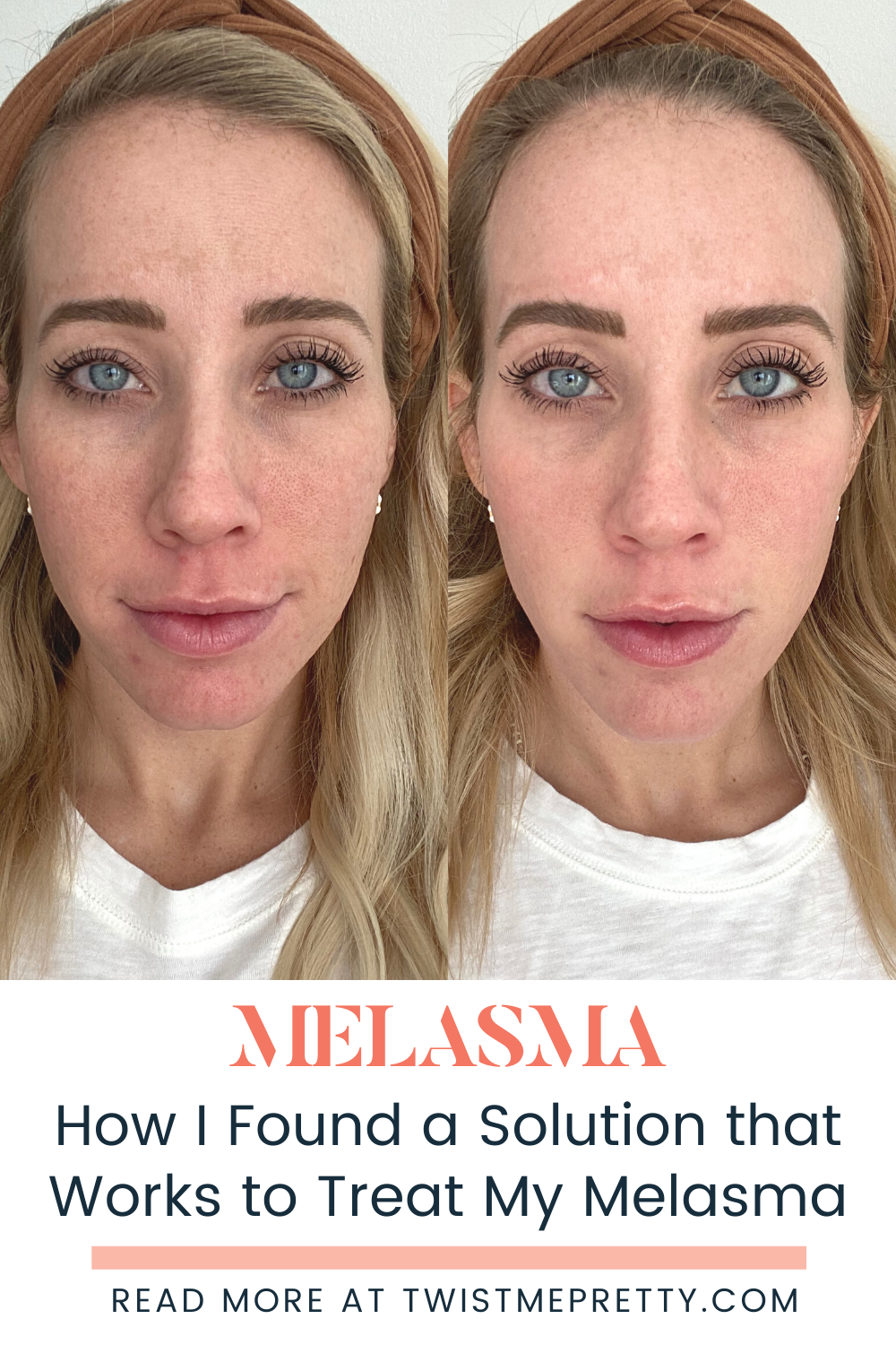 Treating Melasma with The Light and Bright Laser - Twist Me Pretty